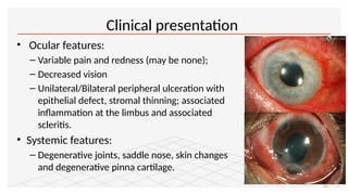 Peripheral Ulcerative Keratitis & Mooren’s Ulcer- Dr. Prabhat Devkota.pptx