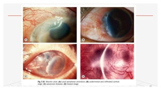 Peripheral Ulcerative Keratitis & Mooren’s Ulcer- Dr. Prabhat Devkota.pptx