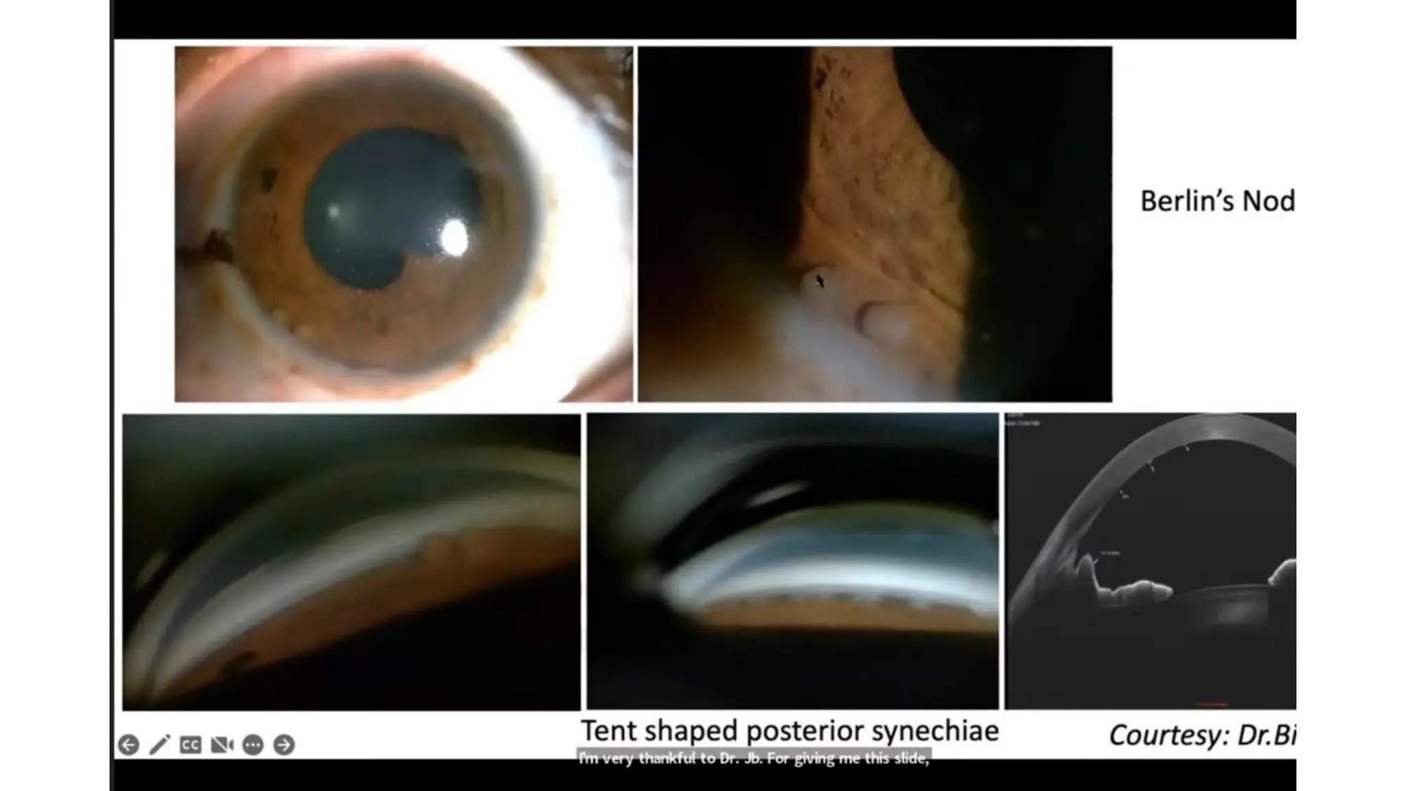 Dr. Sobia Ali PPT Feb-2025 (Sarcoidosis uveitis) | PPTX