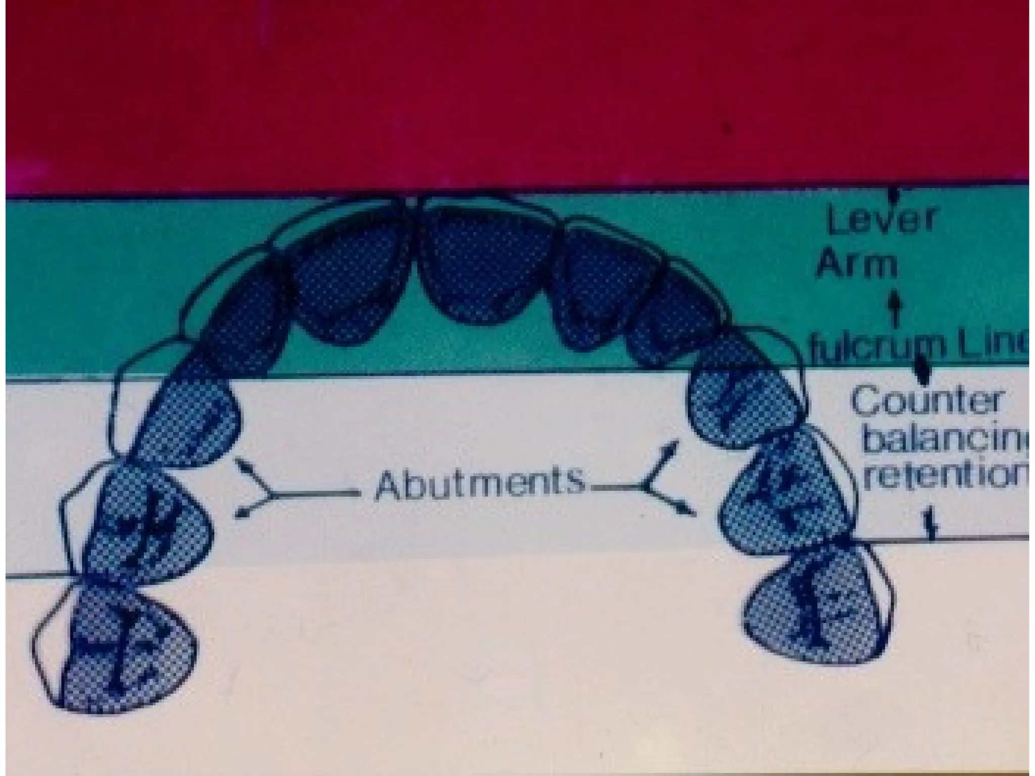 diagnosis and treat planning for Fixed Partial Dentures | PPT