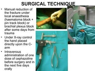 Percutaneous pinning of distal radius (old technique) | PDF