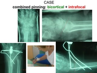 Percutaneous pinning of distal radius (old technique) | PDF