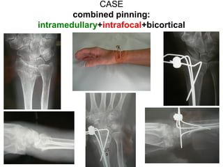 Percutaneous pinning of distal radius (old technique) | PDF