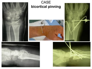 Percutaneous pinning of distal radius (old technique) | PDF