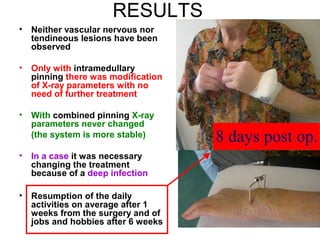 Percutaneous pinning of distal radius (old technique) | PDF