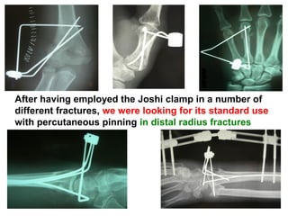 Percutaneous pinning of distal radius (old technique) | PPT