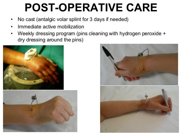 Percutaneous pinning of distal radius (old technique)