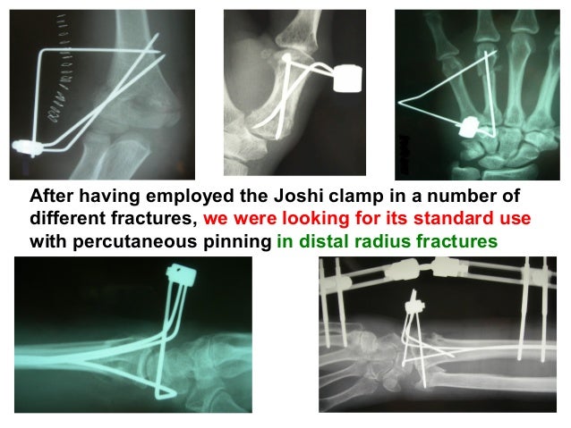 Percutaneous Pinning