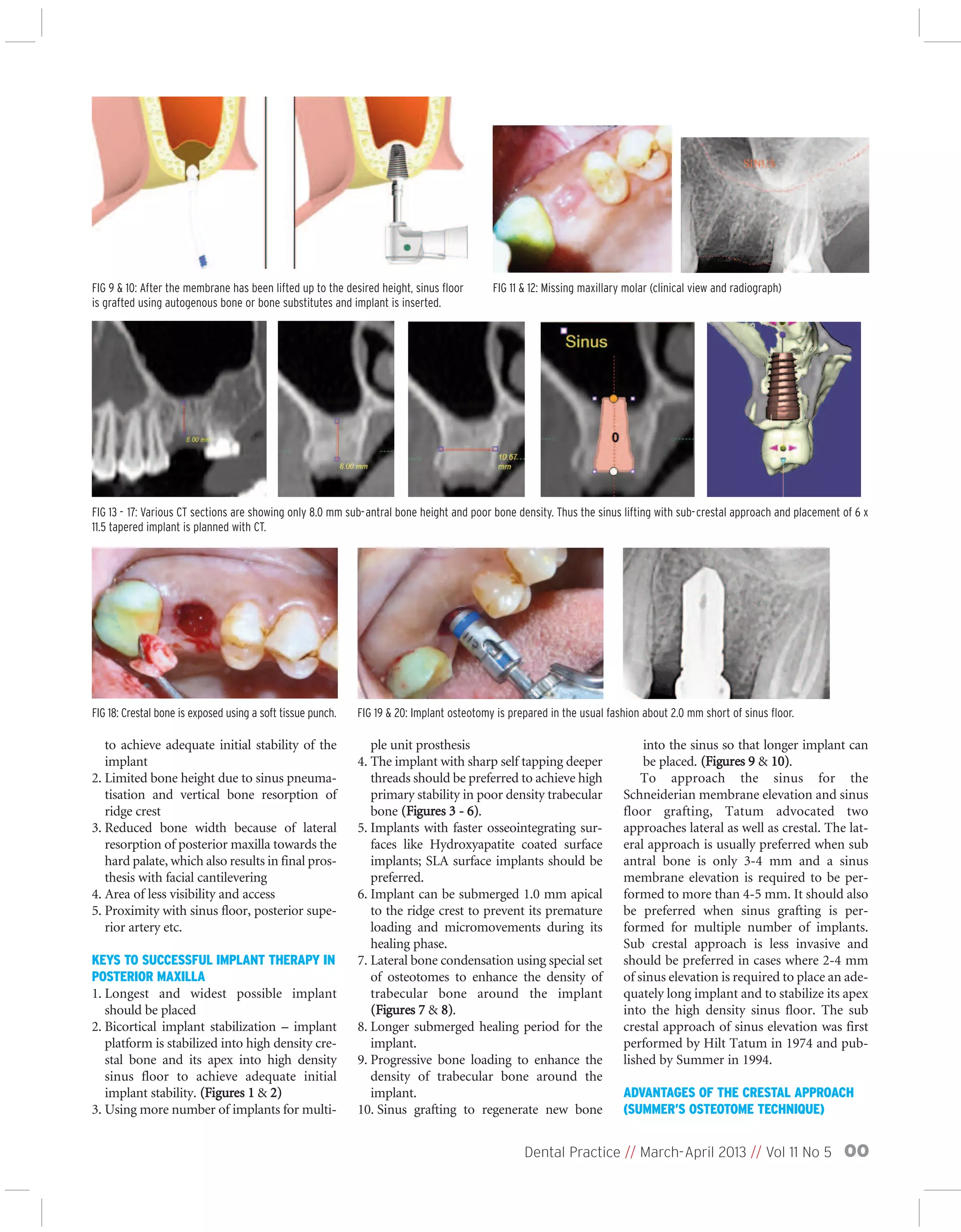 Implant placement in posterior maxilla by Dr. Ajay Singh | PDF
