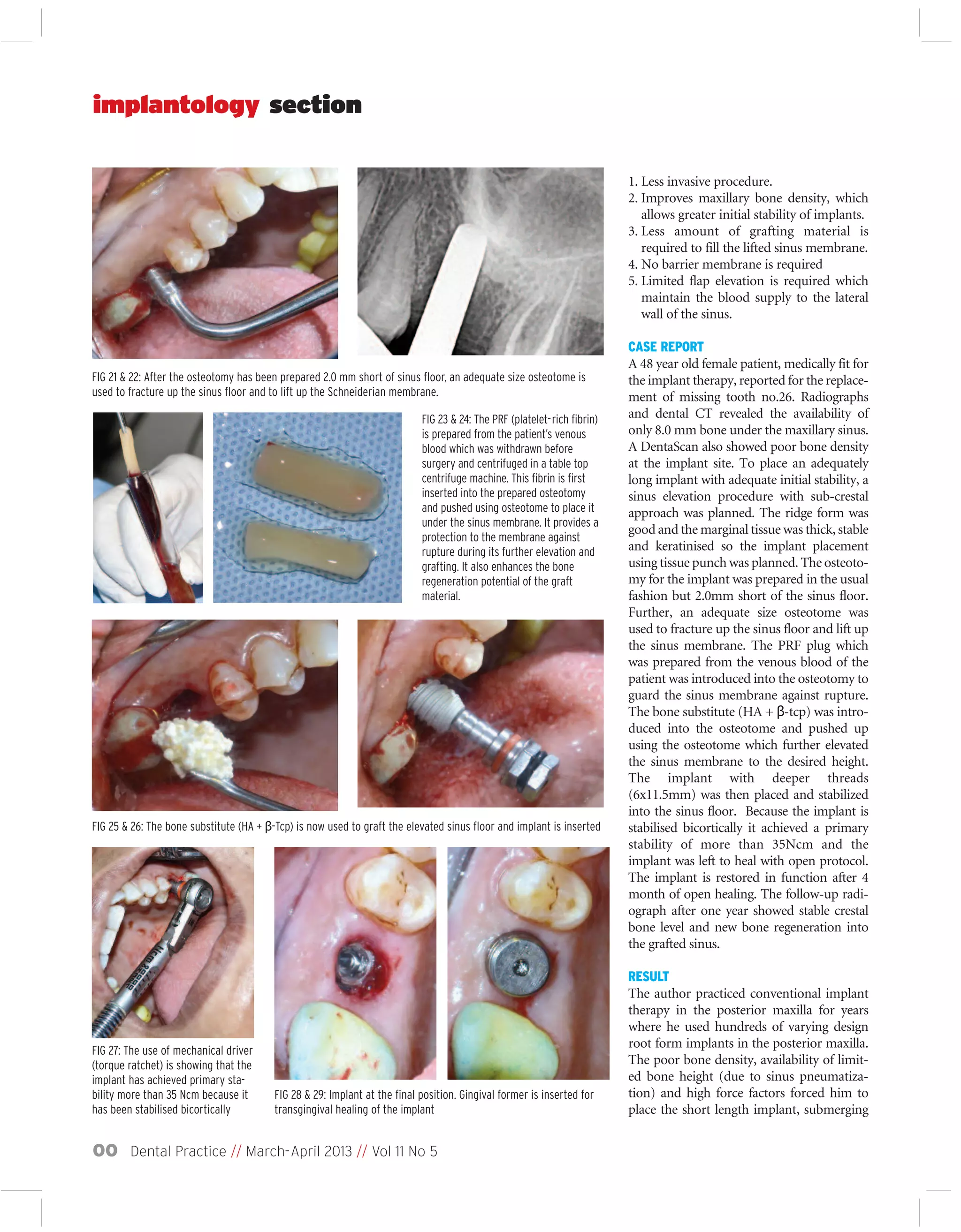 Implant placement in posterior maxilla by Dr. Ajay Singh | PDF
