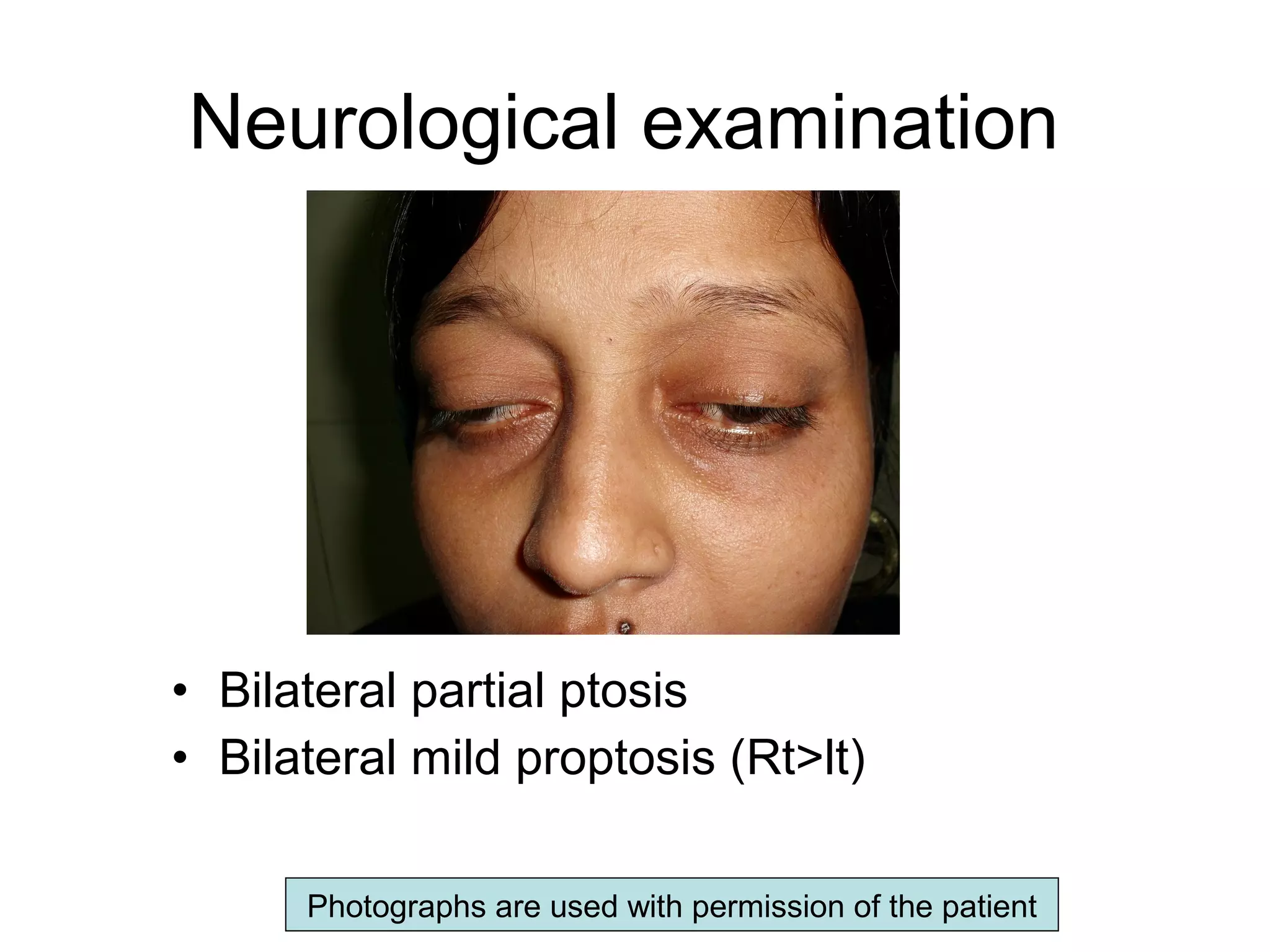 A young lady with progressive neck swelling and bilateral partial ...