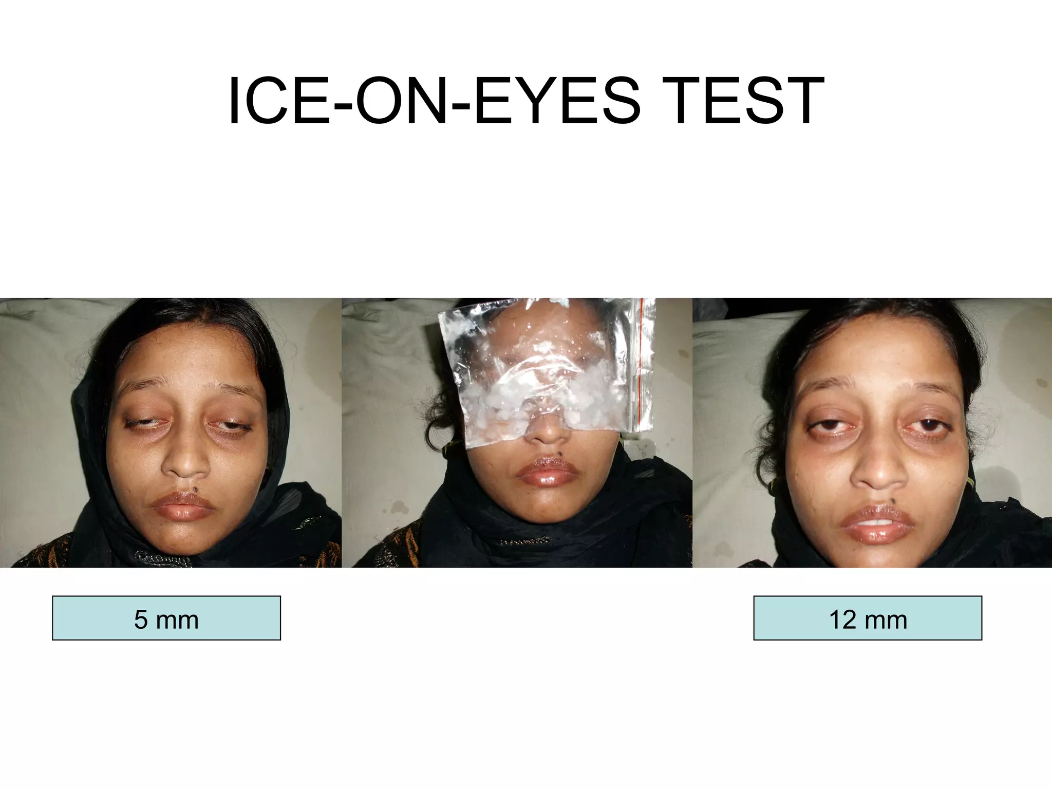 A young lady with progressive neck swelling and bilateral partial ...
