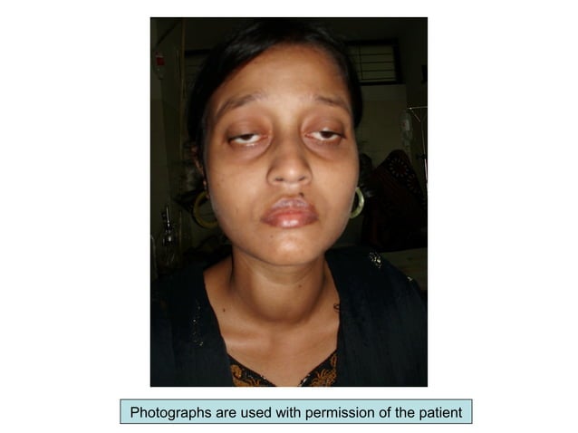 A young lady with progressive neck swelling and bilateral partial ...