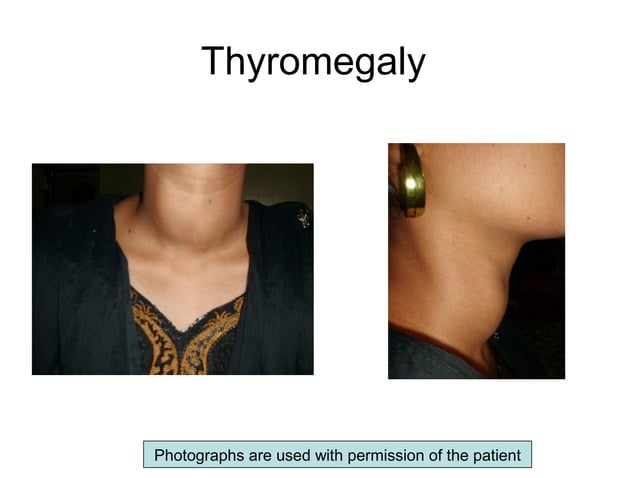 A young lady with progressive neck swelling and bilateral partial ...