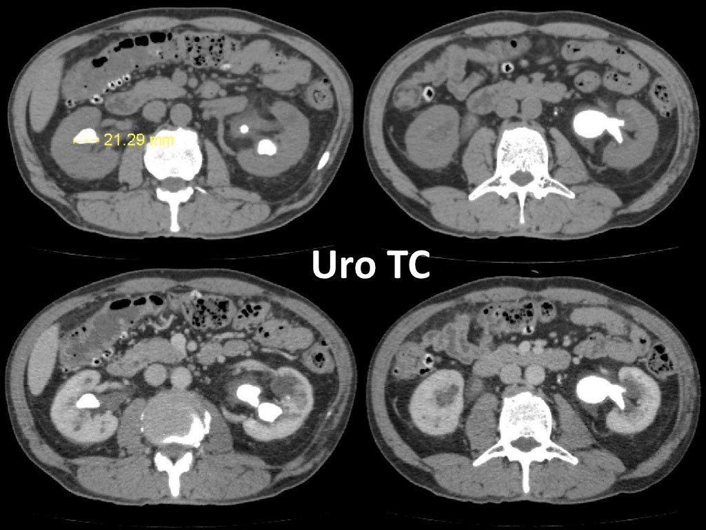 Casos Conceito Cálculo Coraliforme Completo Cálculo Coraliforme Parci…