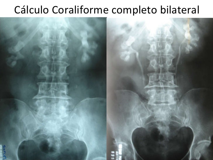 Casos Conceito Cálculo Coraliforme Completo Cálculo Coraliforme Parci…