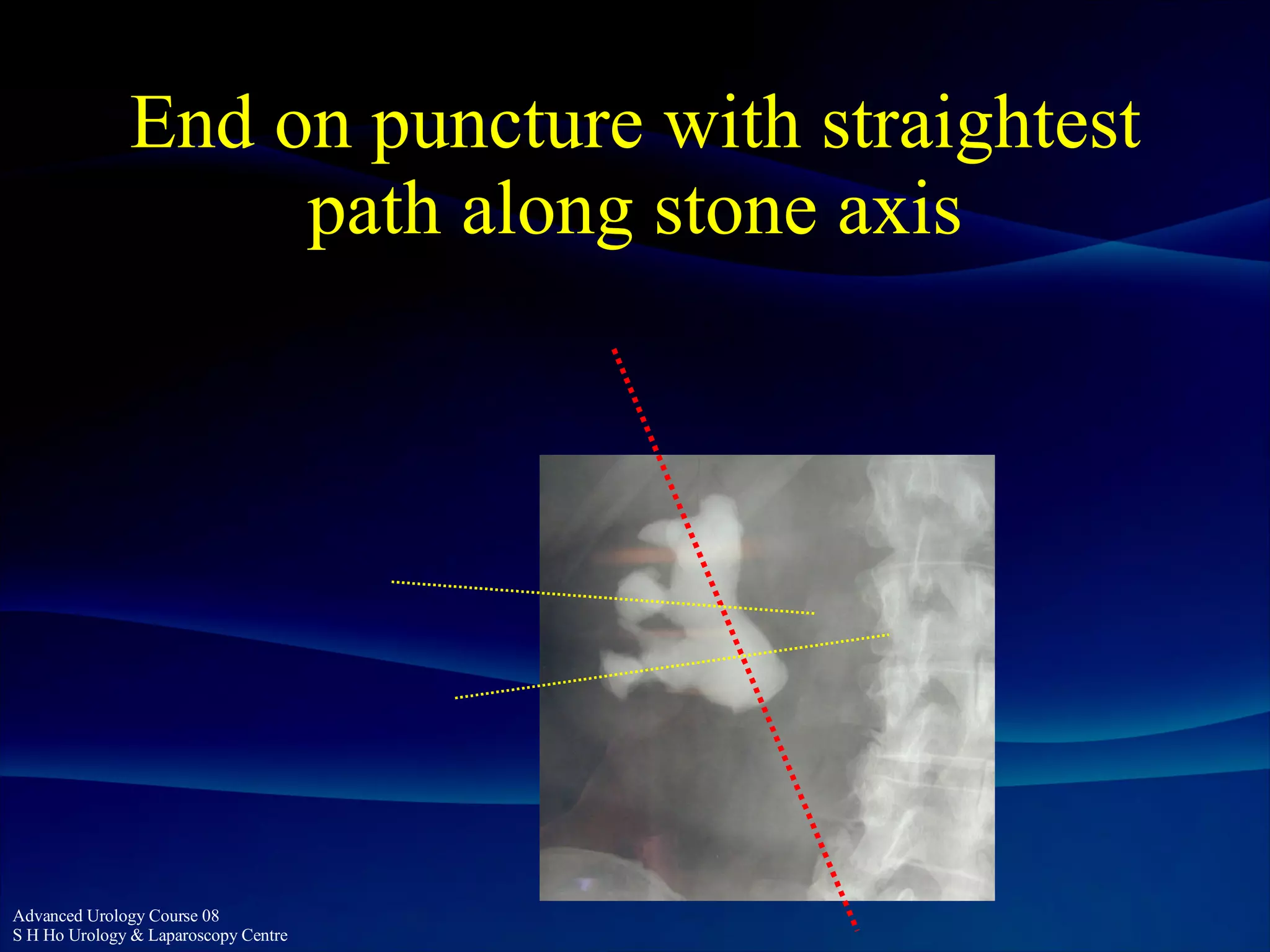 PCNL - the Perfect Puncture | PPT