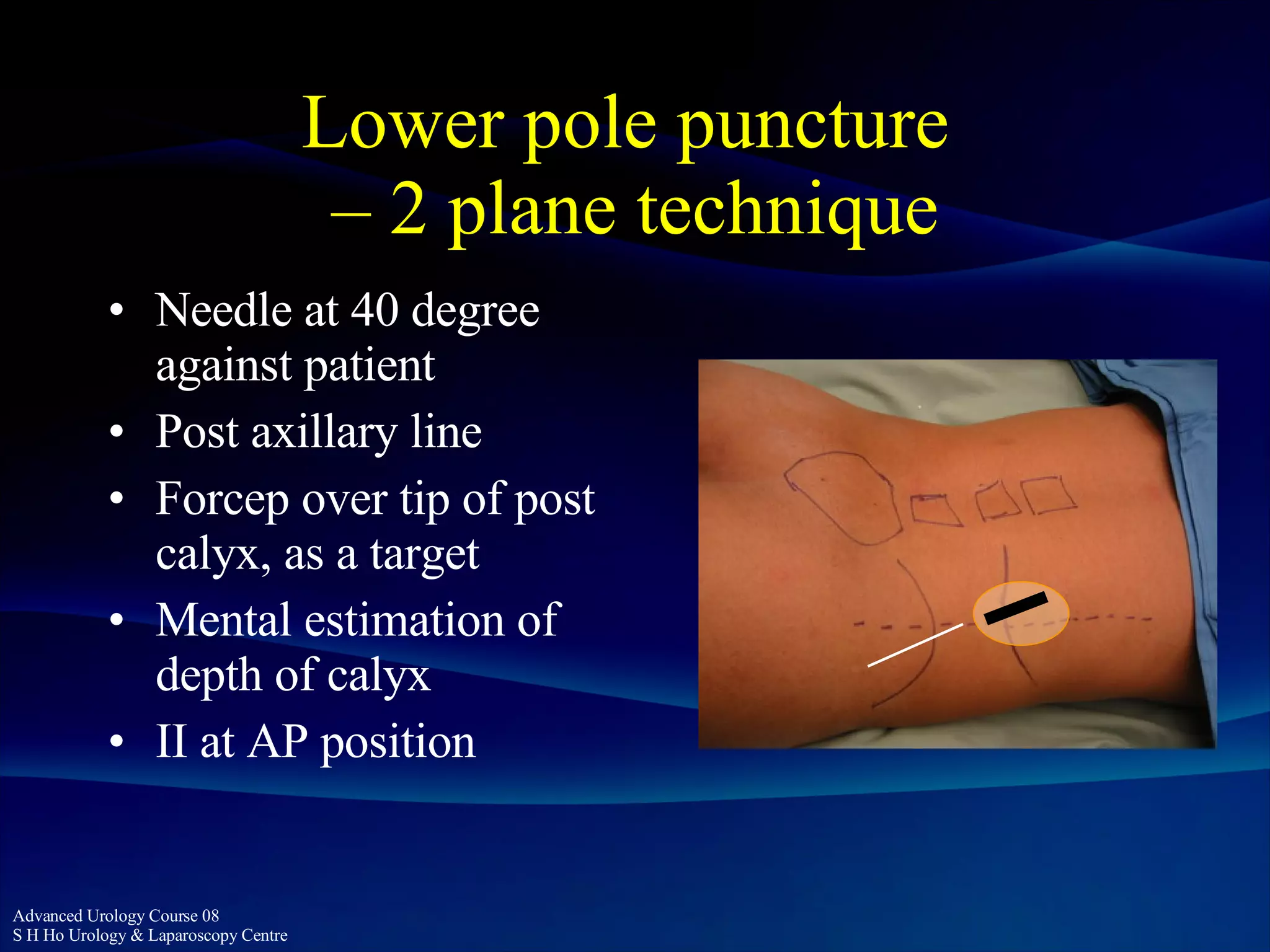 PCNL - the Perfect Puncture | PPT