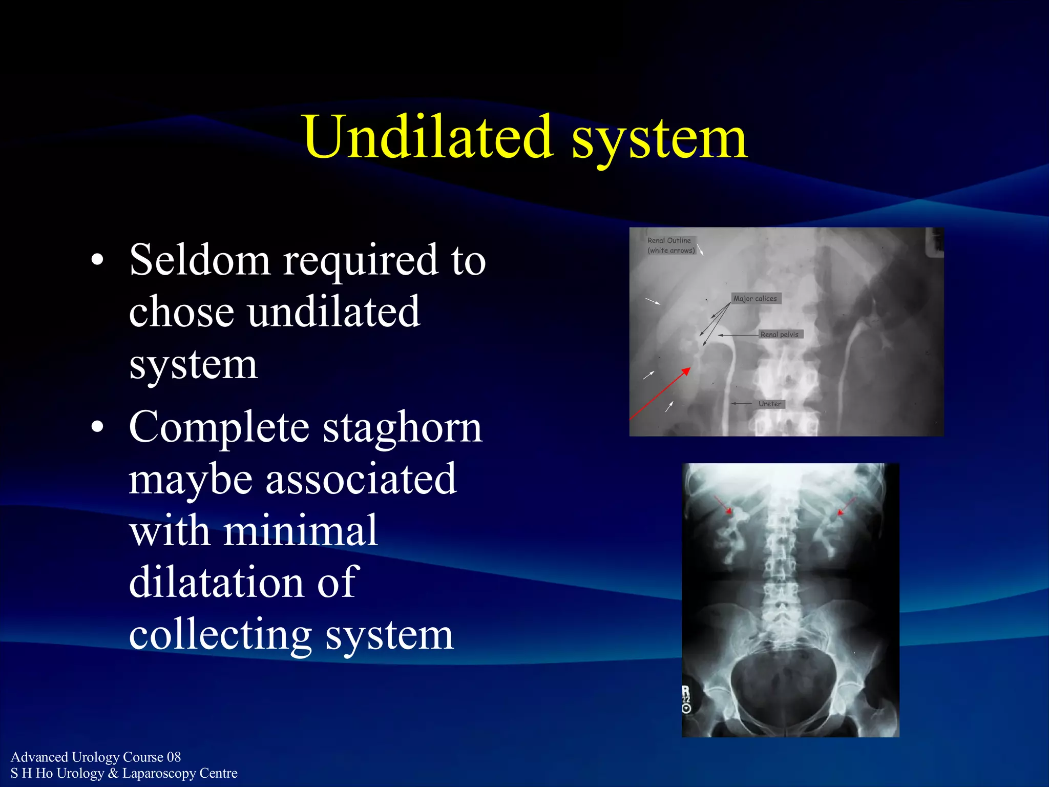 PCNL - the Perfect Puncture | PPT
