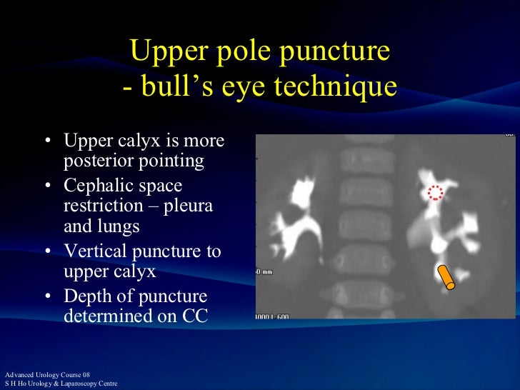 PCNL - the Perfect Puncture