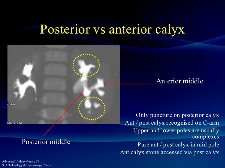 PCNL - the Perfect Puncture