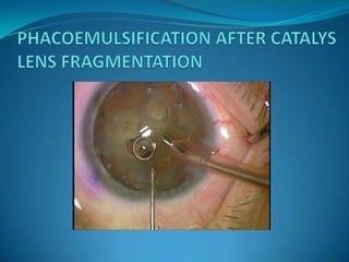 Catalys Office Laser Cataract Surgery | PPT