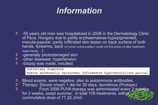 Case 1. Depigmentation therapy in vitiligo universalis with cryotherapy ...