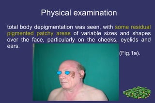 Case 1. Depigmentation therapy in vitiligo universalis with cryotherapy ...