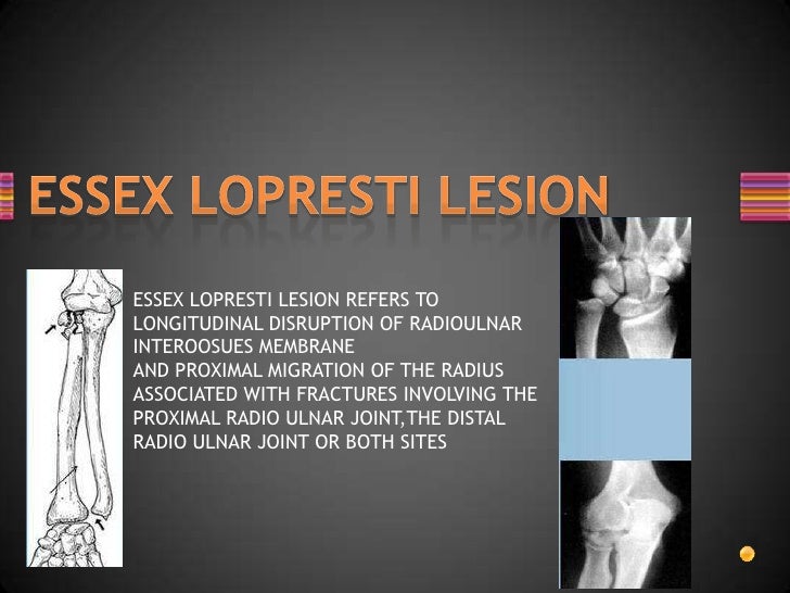 Dr. ms goud management of forearm fractures