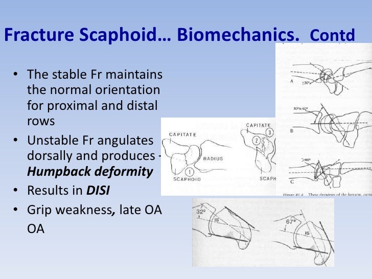 Dr. nagamunindrudu fractures of scaphoid