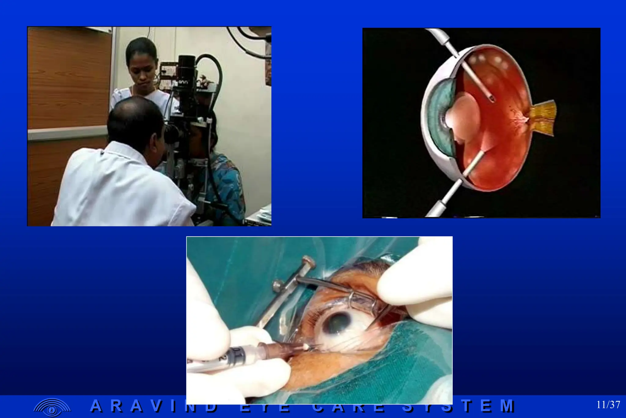 DR-Perumalsamy-Namperumalsamy_Diabetic-Retinopathy.ppt