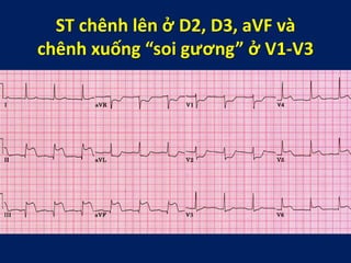 Tổng quan về hình ảnh soi gương trong nhồi máu cơ tim hiểu rõ hơn về ...