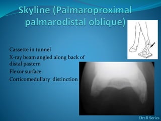 Dr rahimzadeh-navicular syndrome | PPTX