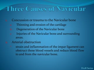 Dr rahimzadeh-navicular syndrome | PPTX
