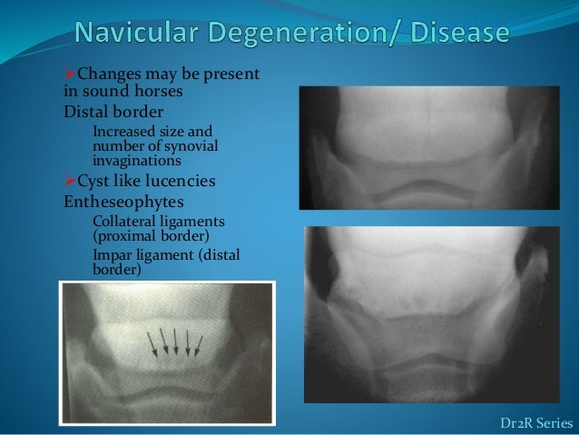 Dr rahimzadeh-navicular syndrome