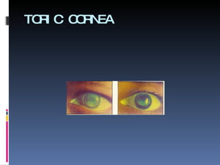 Hard Contact Lenses | PPT