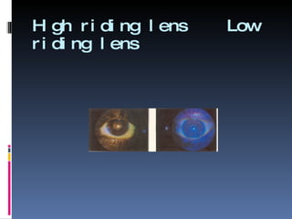 Hard Contact Lenses | PPT