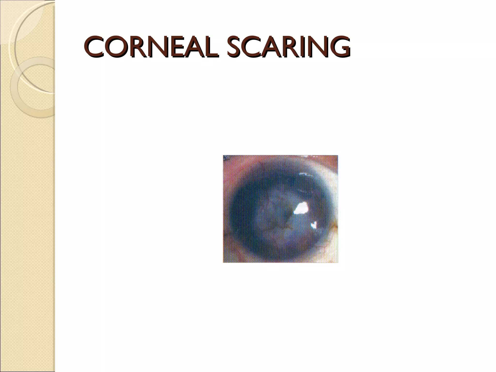 Vitamin A Deficiency & Eye | PPT