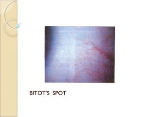 Vitamin A Deficiency & Eye | PPT