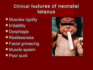 Dr.tosif tetanus in the new born | PPT
