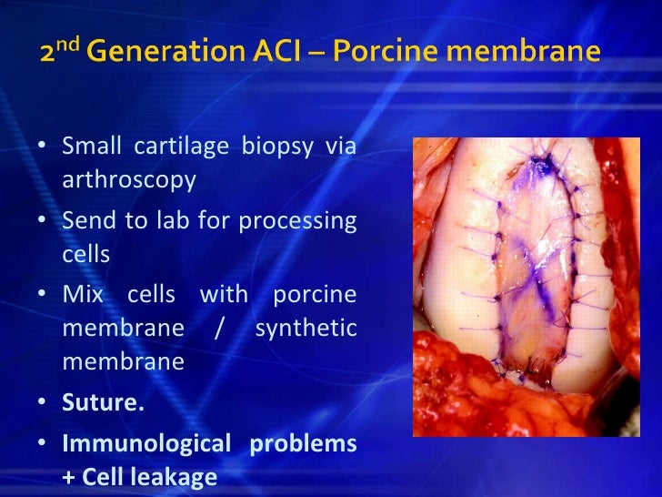 Knee Cartilage surgery in India