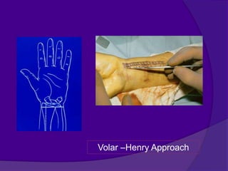 Dr. yt reddy distal radius fractures modified | PPTX