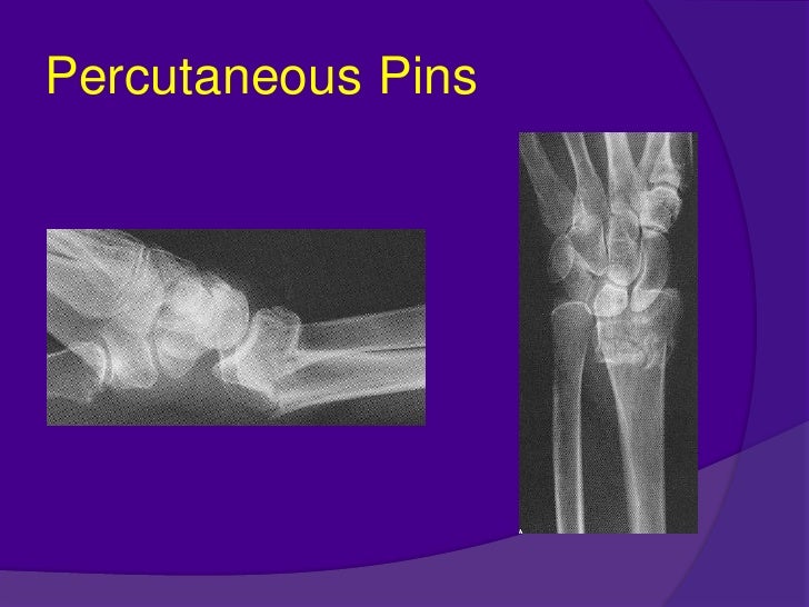 Dr. yt reddy distal radius fractures modified