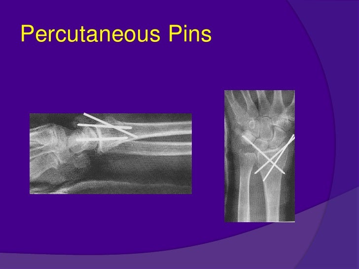 Distal Radius Fracture Kapandji Intrafocal Pinning Technique