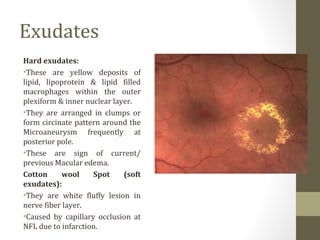 Diabetic Retinopathy | PPT