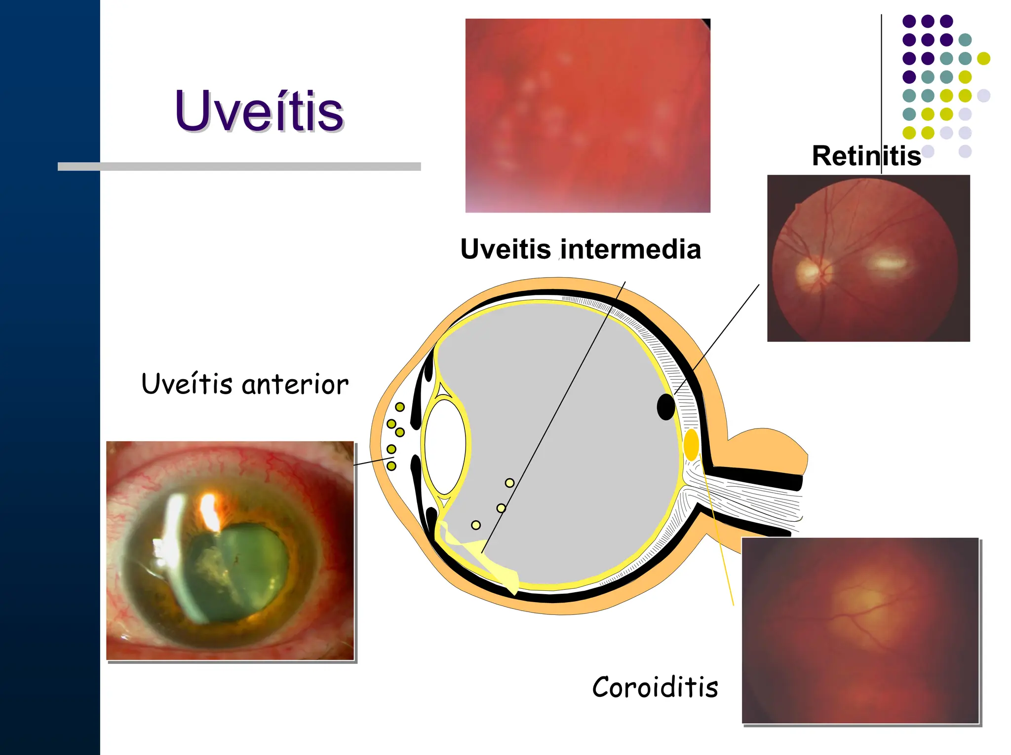 Uveitis diagnostico y tratamiento presentacion | PDF