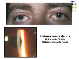 Uveitis diagnostico y tratamiento presentacion | PDF