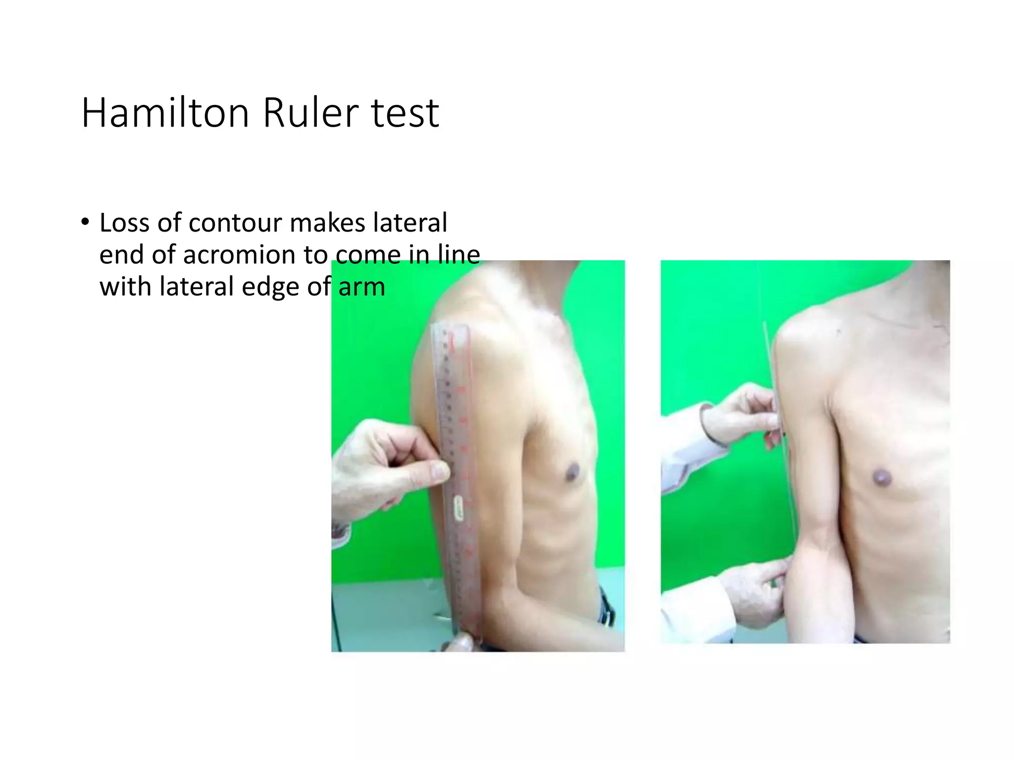shoulder injuries.pptx