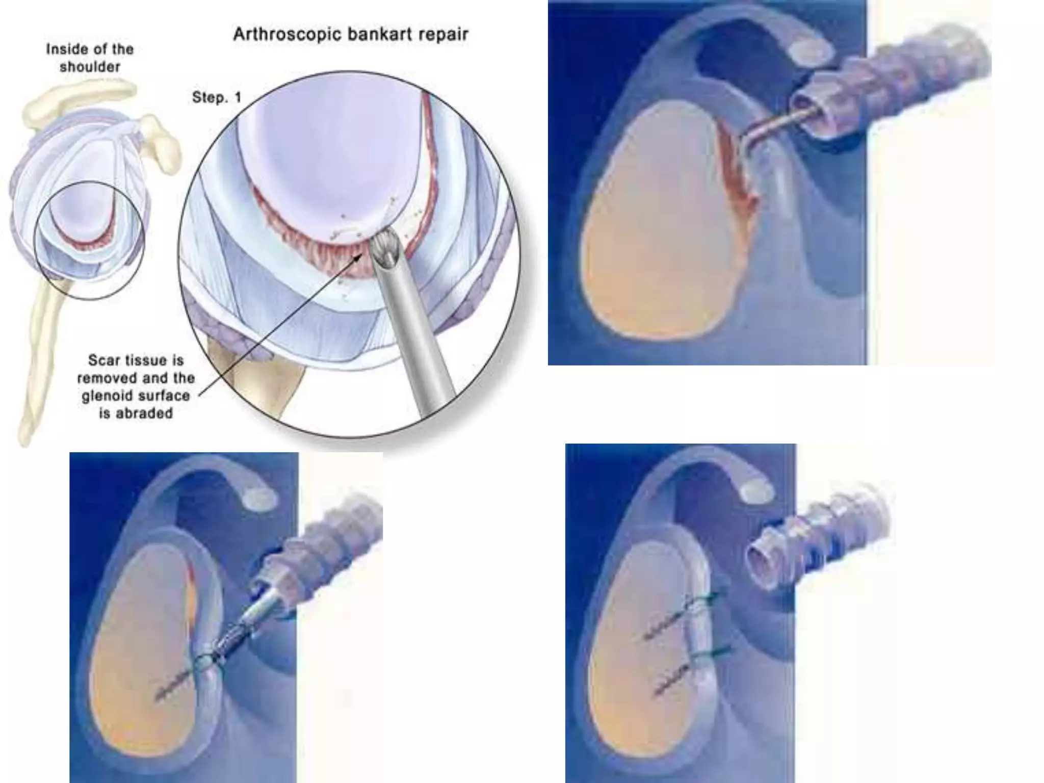 Shoulder Injuriespptx