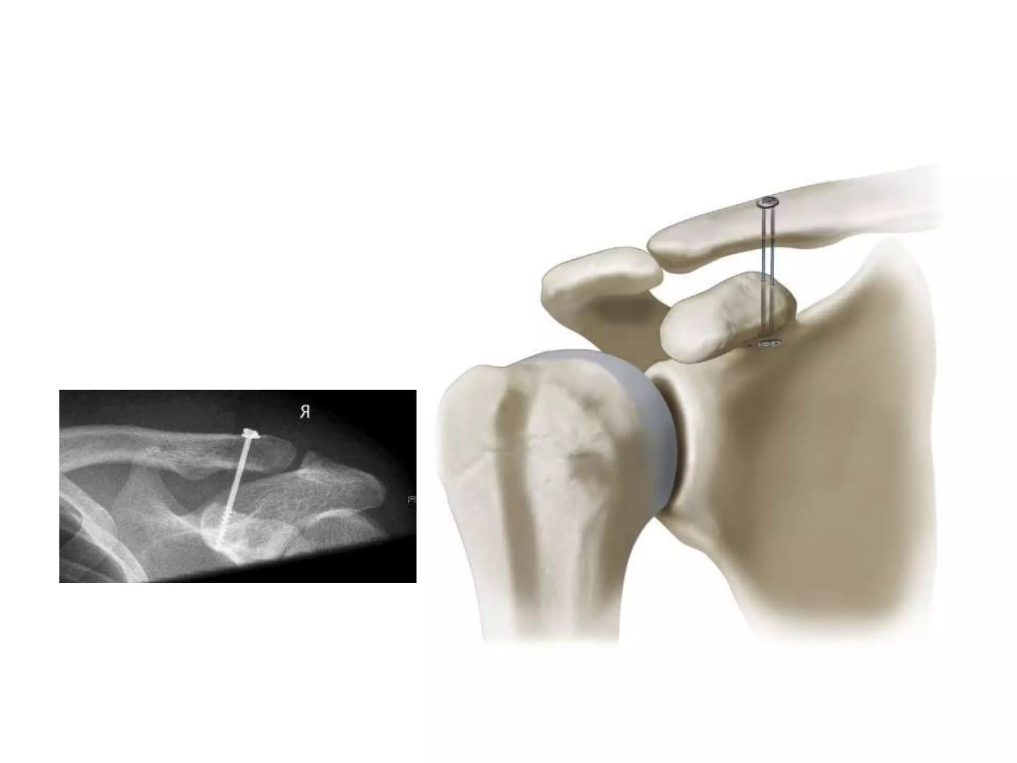 Shoulder Injuriespptx